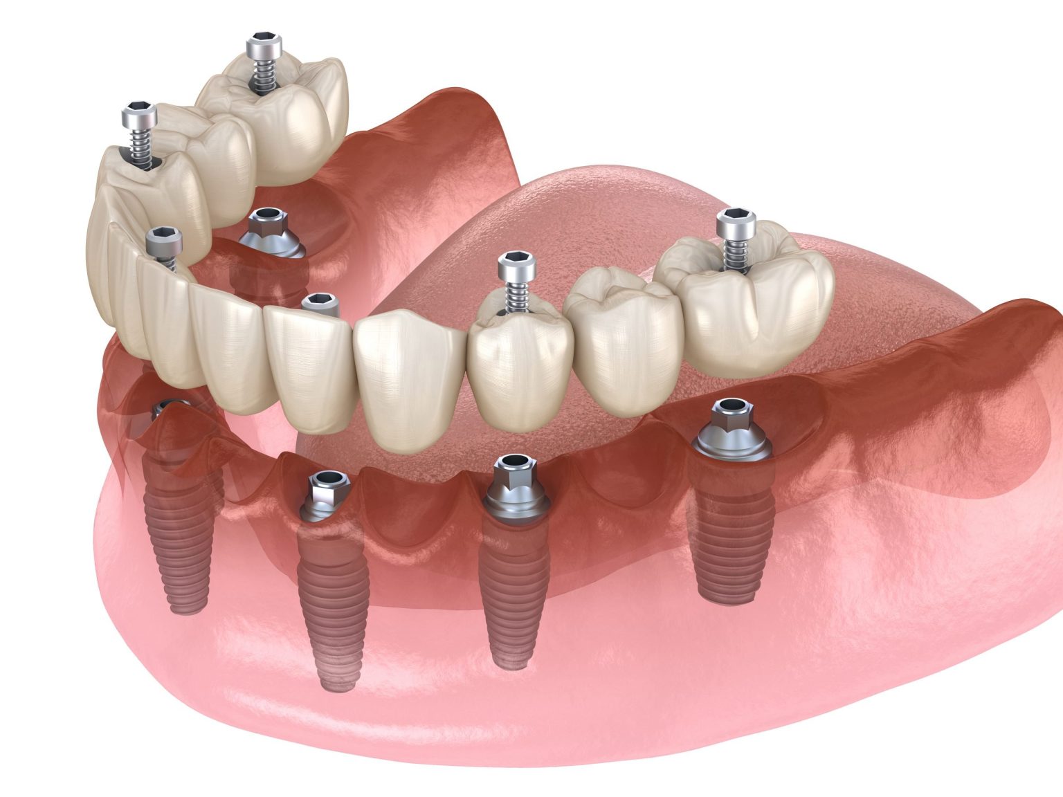 San Antonio, TX Dental Implants - Long-lasting Solution - Advanced ...